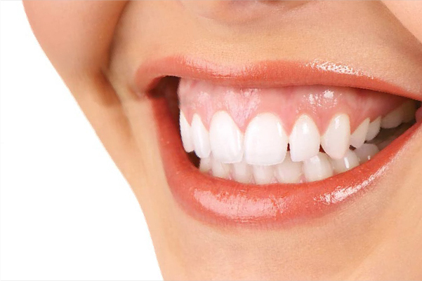 Gummy Smile - Gingival Plasty | Maryclinic.am