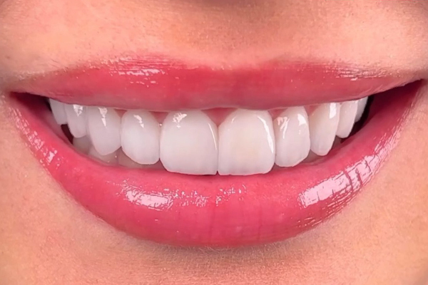 Restoration of teeth using ceramic crowns | MaryClinic.am
