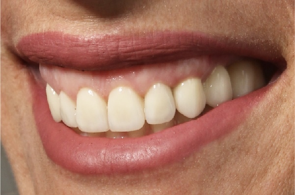 When can an implant be placed after tooth extraction?